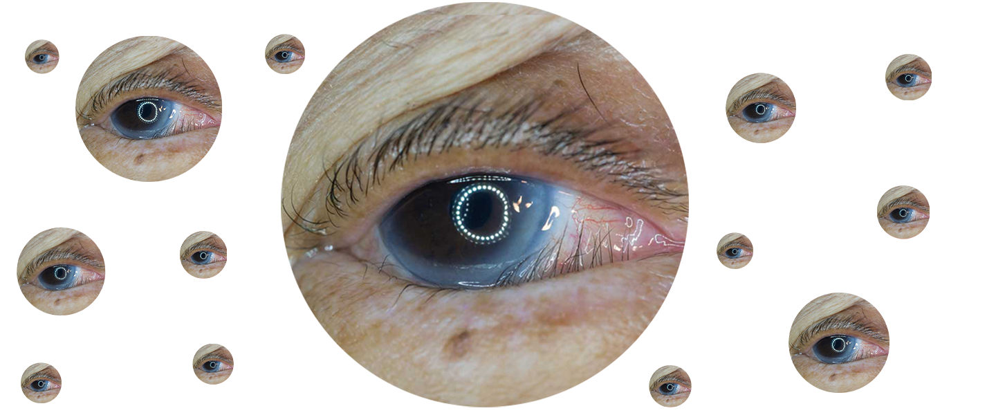Entropion - Op. Dr. Yıldız Acar Ebcim